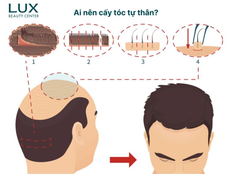 CẤY TÓC TỰ THÂN LÀ GÌ? CÓ HIỆU QUẢ KHÔNG? TÌM HIỂU ƯU, NHƯỢC ĐIỂM